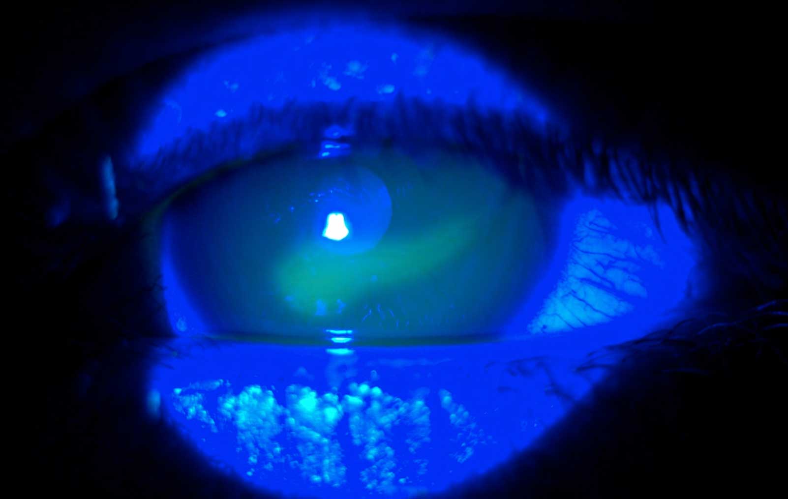 Corneal Abrasion OPTOCASE Corneal Abrasion OPTOCASE