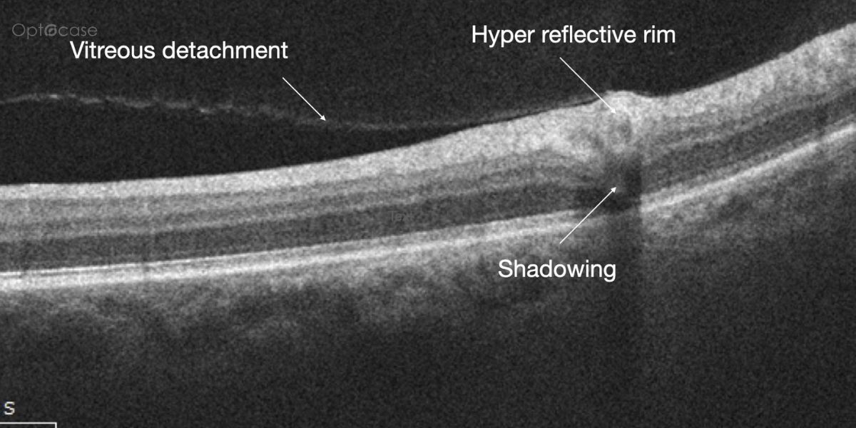 Inner Retinal Thickening in Hypertensive Patient - OPTOCASE