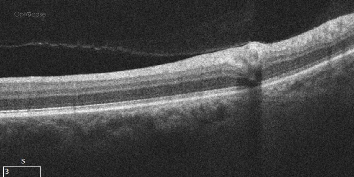 Inner Retinal Thickening in Hypertensive Patient - OPTOCASE