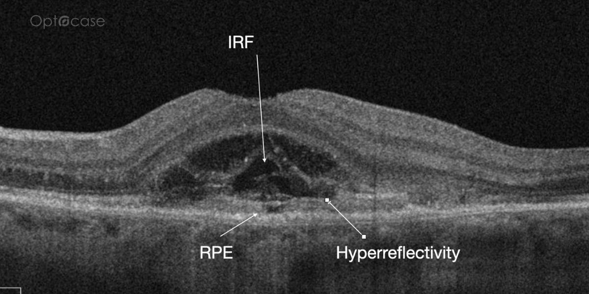 Deep Elevation - OPTOCASE