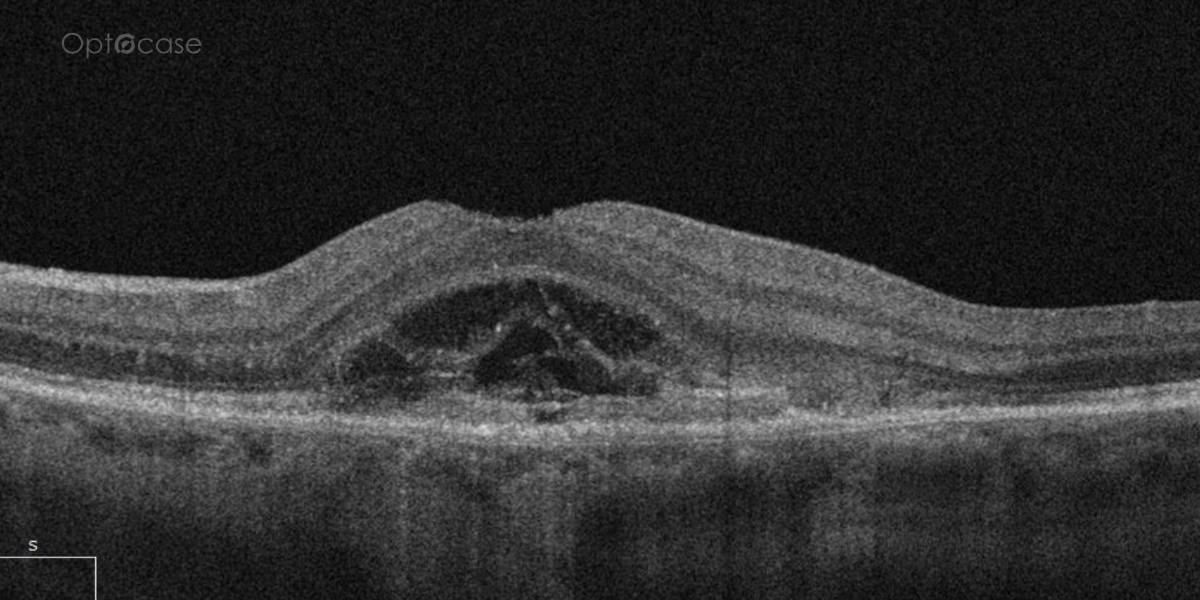 Deep Elevation - OPTOCASE