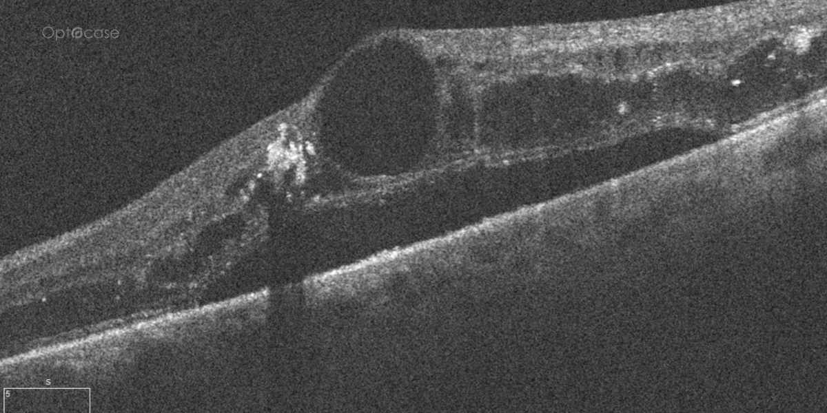 Elevation of Deep Retina - OPTOCASE