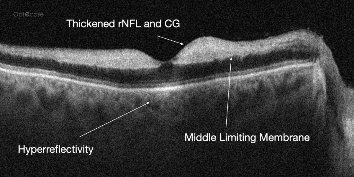Thickened Inner Retina - OPTOCASE