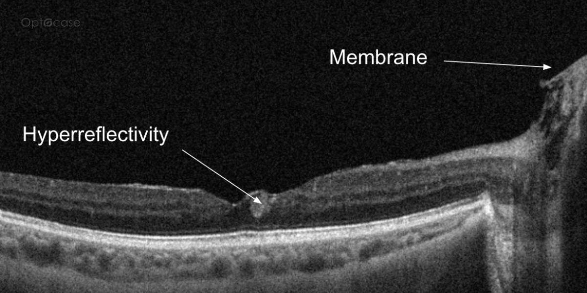Focal Retinal Thickening - OPTOCASE