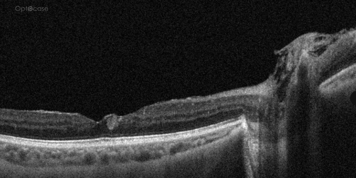 Focal Retinal Thickening - OPTOCASE