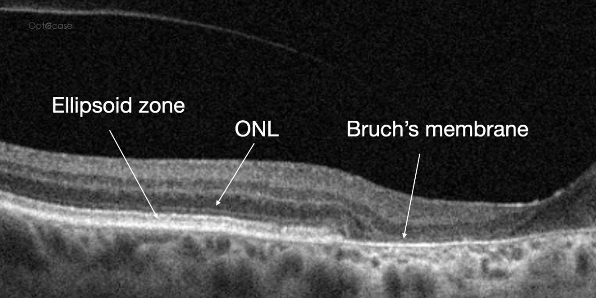 Outer Retina Thinning + Linear Pigment - OPTOCASE