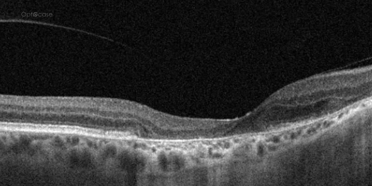 Outer Retina Thinning + Linear Pigment - OPTOCASE