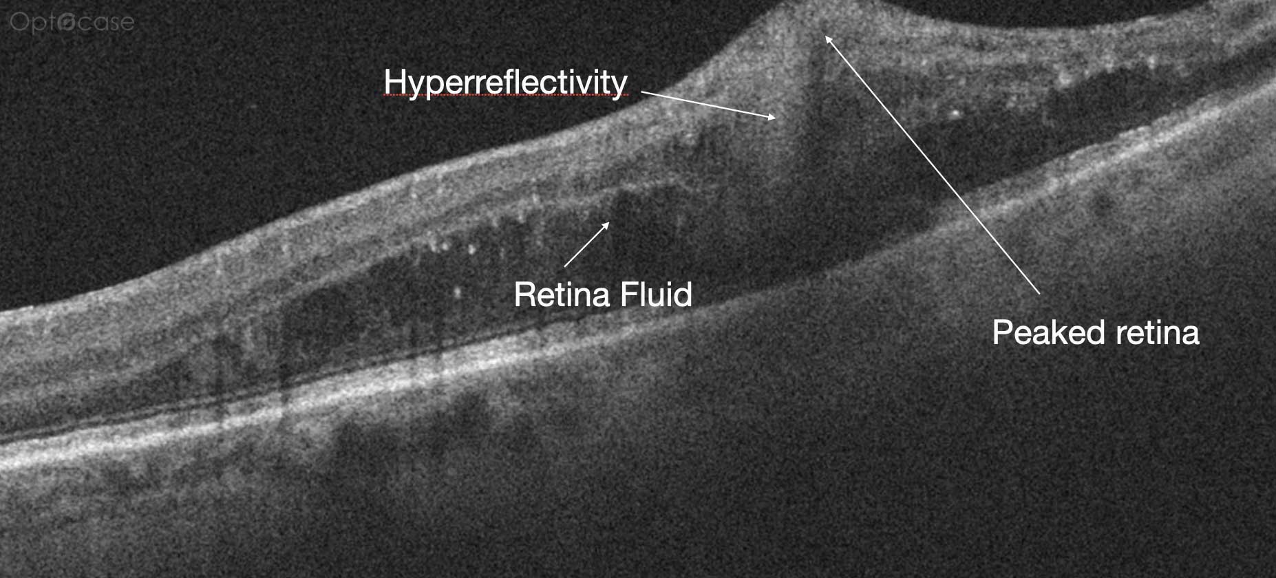 Inner Retinal Thickening - OPTOCASE