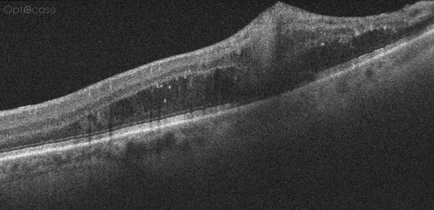 Inner Retinal Thickening - OPTOCASE