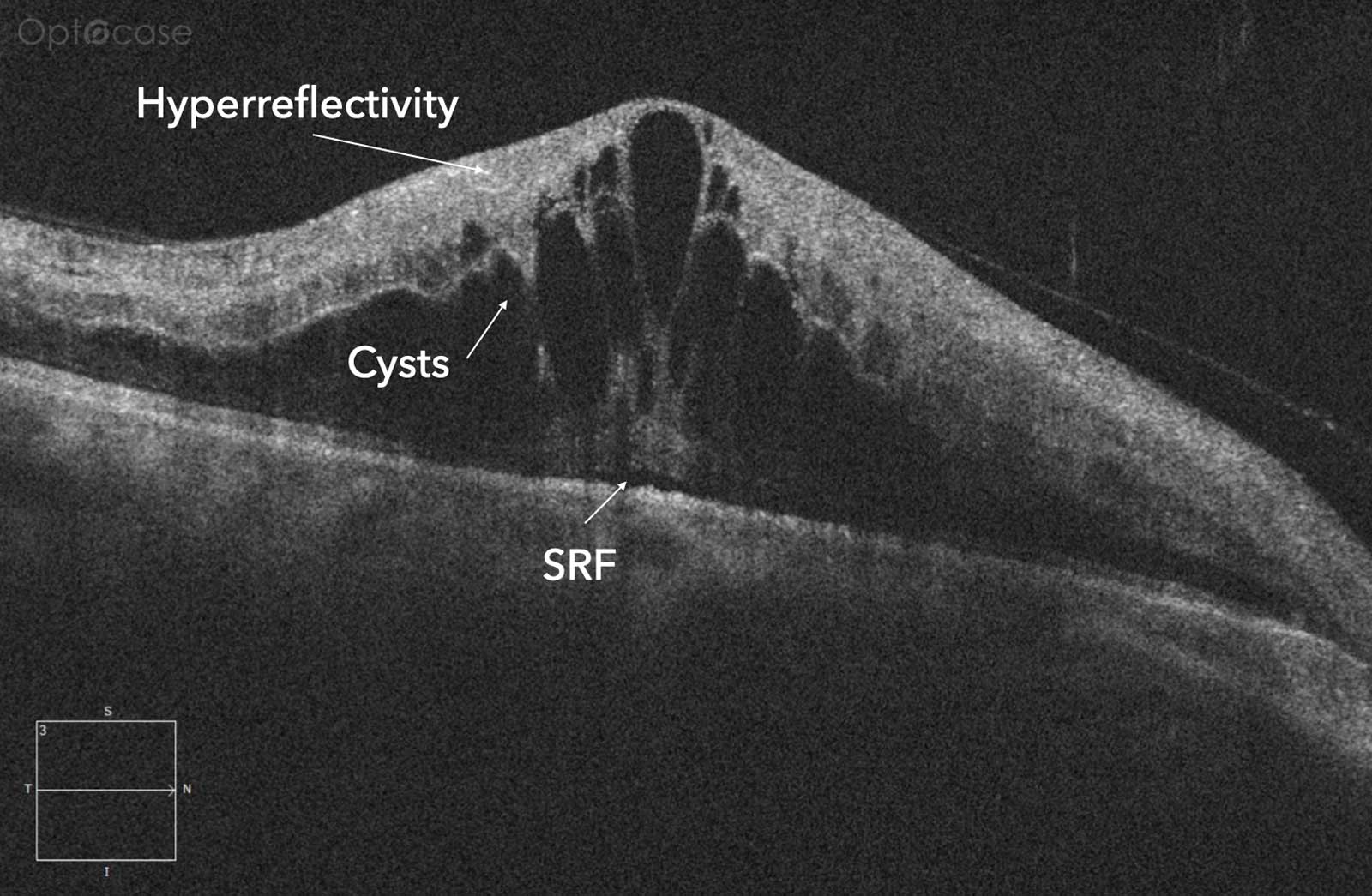 Peaking of the Retina - OPTOCASE