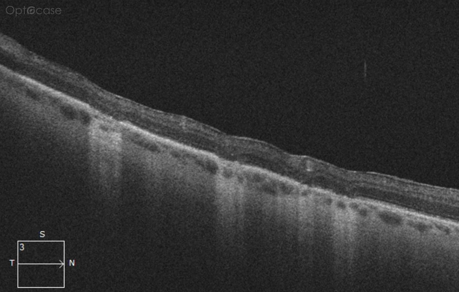 Deep Retinal Hyperreflectivity - OPTOCASE
