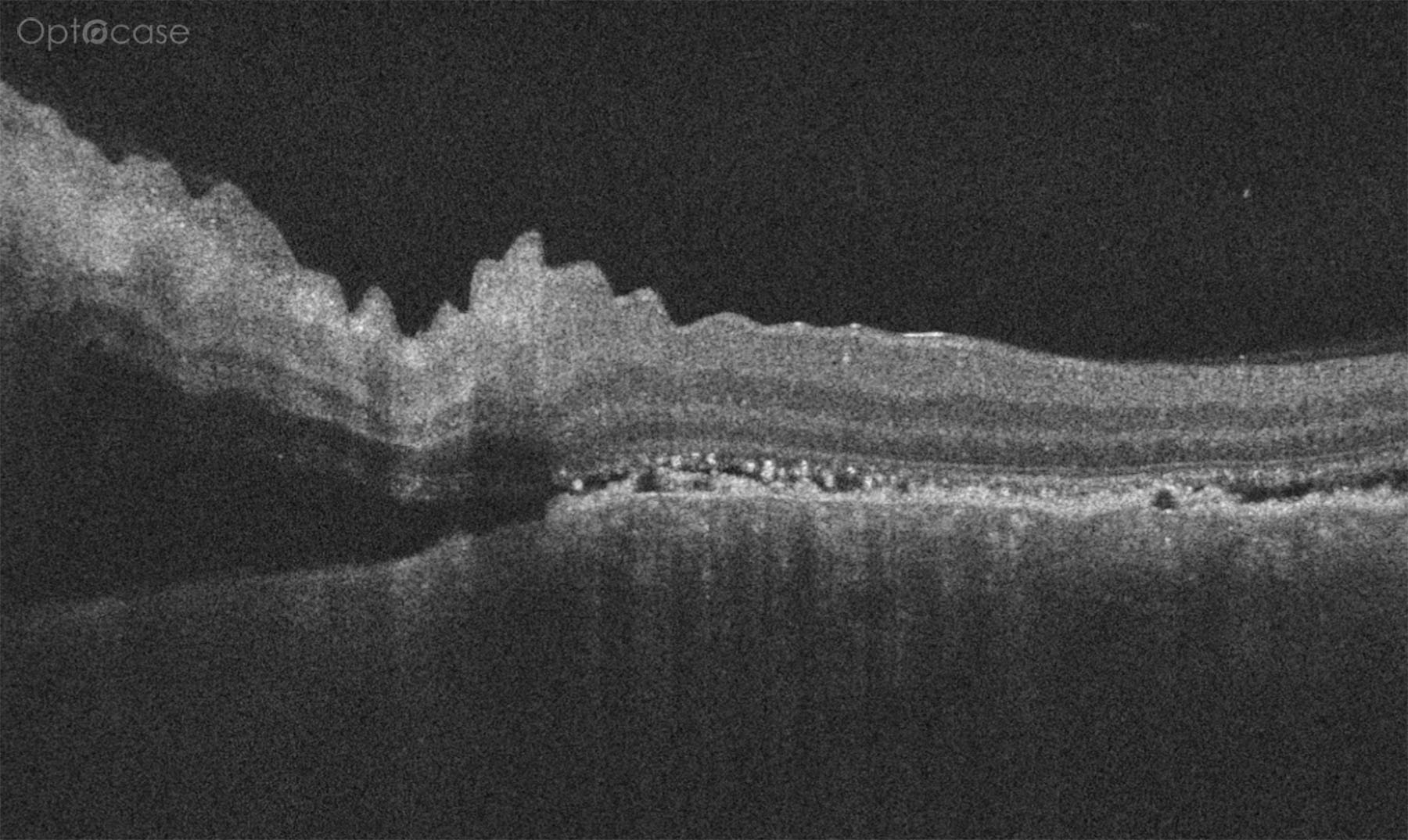Blurred Vision and Subretinal Fluid - OPTOCASE