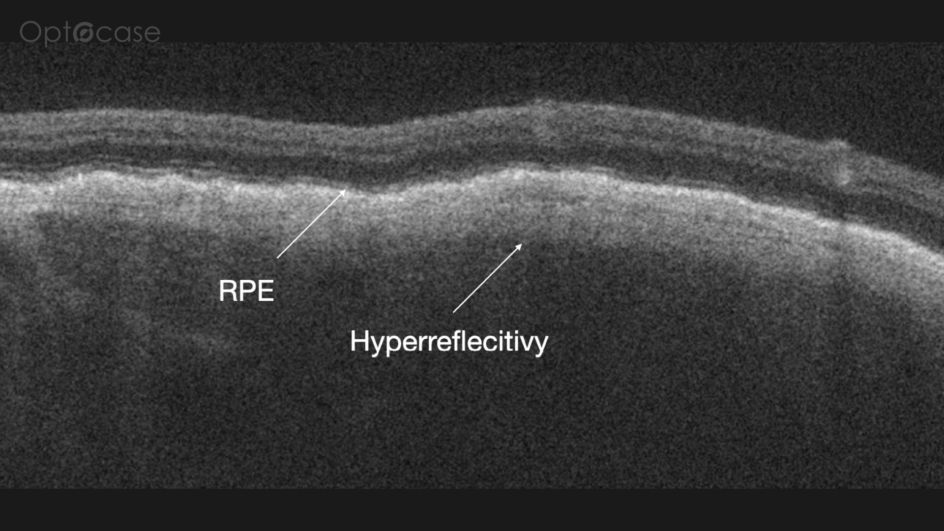 Deep Retinal Elevation - OPTOCASE