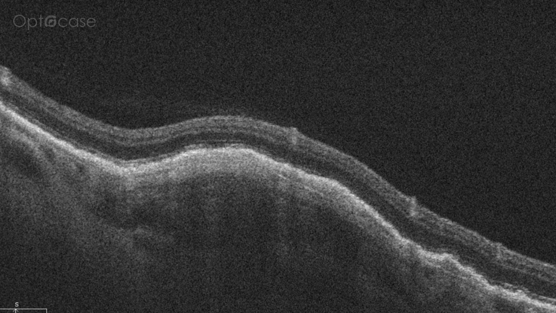 Deep Retinal Elevation - OPTOCASE